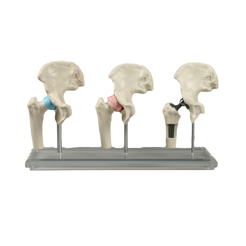 Hip Implant Comparison Set | Erler Zimmer 1115 | Candent